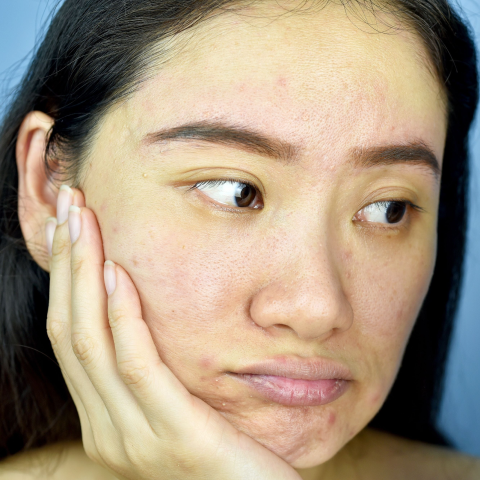 Do I Have Fungal Acne? Here’s How to Tell and What to Do About It – DERMALA
