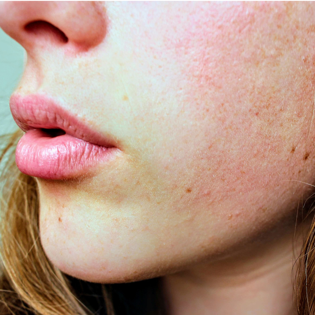 5 Tips to Calm Inflamed Skin – DERMALA