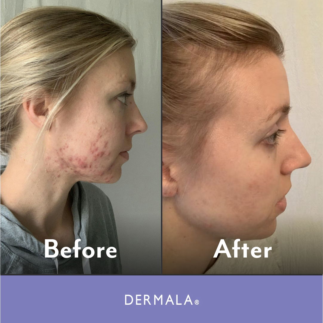 SUPPLEMEANT to Be® | Acne Probiotic Supplement – DERMALA